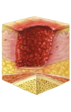 Pressure injury categories - careofsweden