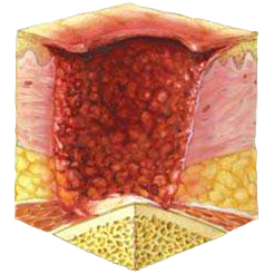 Pressure injury categories - careofsweden